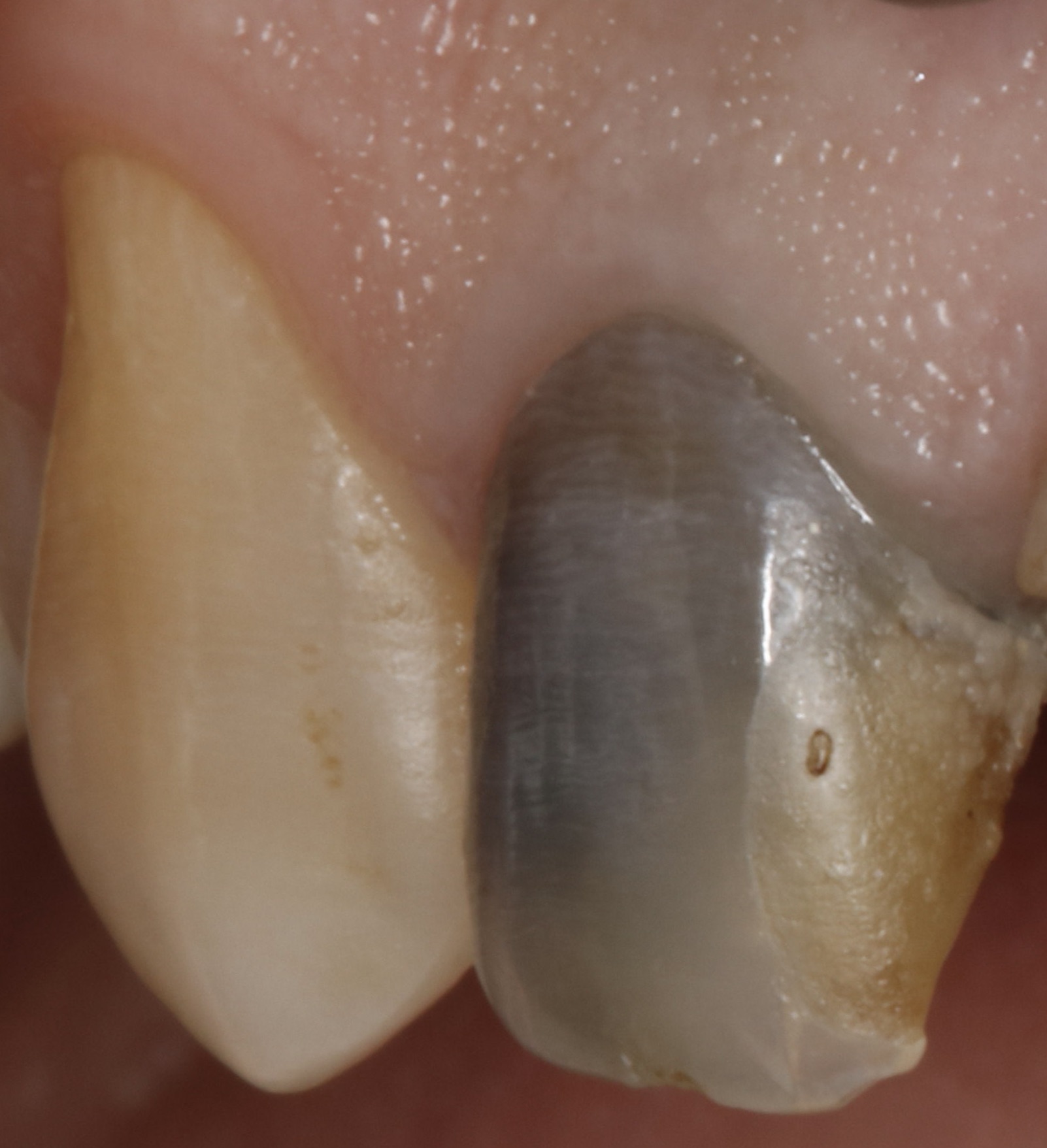 Dientes negros - Clínica Dental Cortés Martinicorena. Centro de ...