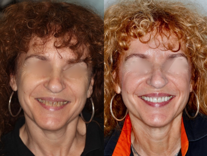 Dientes negros - Clínica Dental Cortés Martinicorena. Centro de ...